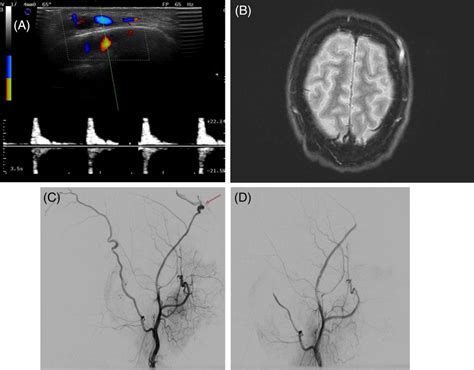 A Doppler Ultrasound Image Tubular Anechoic Structure With High‐flow