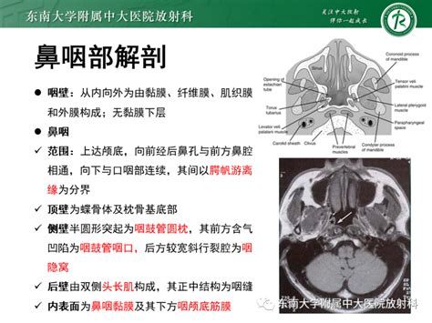【ppt】鼻咽癌影像及分期 影像ppt