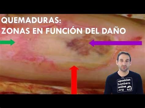 ¿cómo Saber Si Una Quemadura Está Infectada Guía Completa Para
