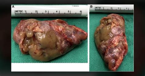 Woman Suffers From High Ipth Despite Treatment Medsynapse