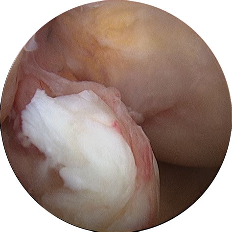 Before After Acl Tear Acl Reconstruction With Hamstring Autograft — Christopher J Wahl Md