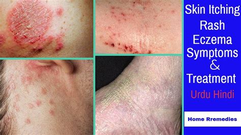 Skin Itching Skin Eczema Symptoms And Treatment In Urdu And Hindi With