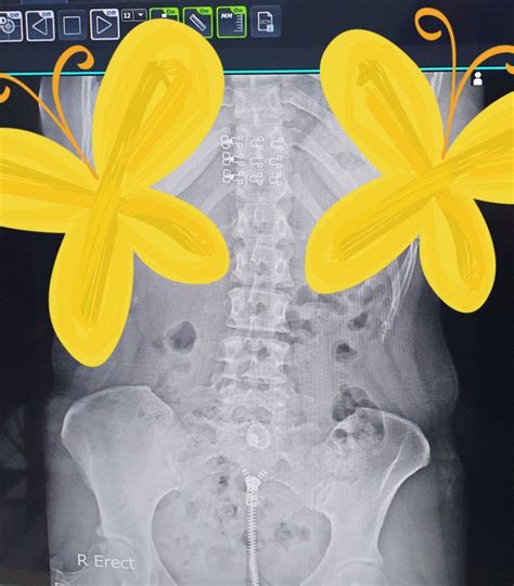 제 척추 휜 정도 좀 봐주세요 지식in