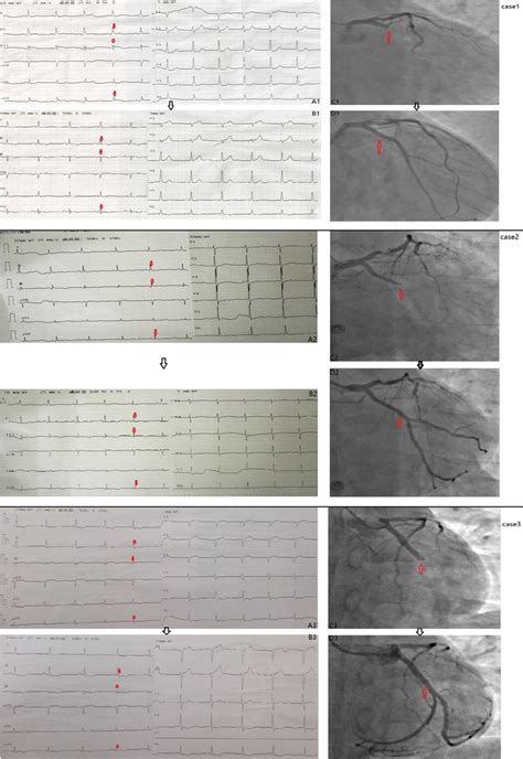 The Electrocardiograms And The Coronary Angiograms Before And After Pci