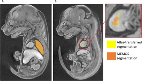 a comparison of the abm and memos segmentations of the a left lung