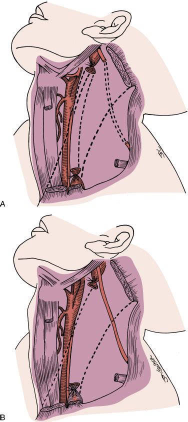 Radical Neck Dissection Ento Key