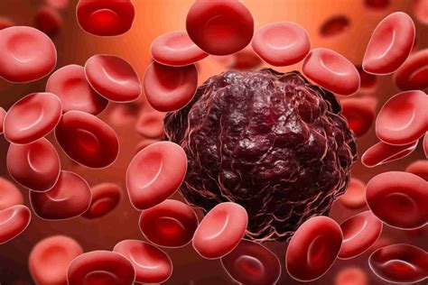 Ziftomenib A Promising New Treatment For Npm1 Mutated Acute Myeloid
