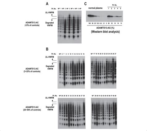 Plasma Vwf Multimer In 49 Lc Patients With Severe To Mild Deficiency Of