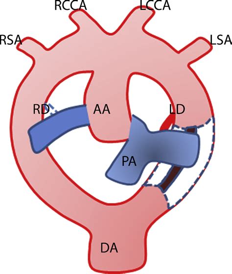 Rings And Slings Revisited Magnetic Resonance Imaging Clinics