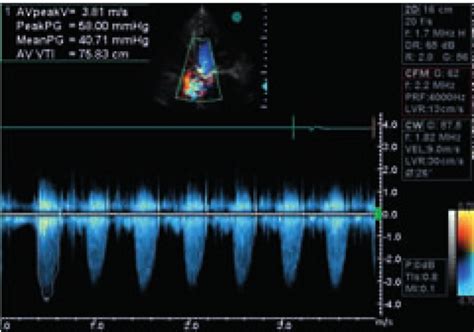 Spectral Analysis Of Aortic Valve Flow From Apical Chamber View In Download Scientific