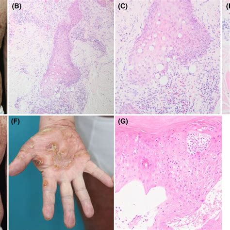 A Disseminated Pruritic Redtobrown Papules On The Trunk BD Download Scientific Diagram