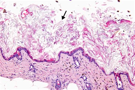 Hyperkeratosis Icd 10