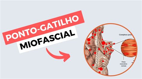 Saiba mais sobre o que é um PONTO GATILHO MIOFASCIAL trigger point
