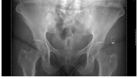 Anteroposterior Radiograph Of Pelvis Showed Sclerosis And Download
