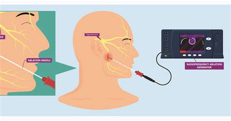 Radiofrequency Ablation Purpose Preparation Aftercare Recovery Results Risks And Complications