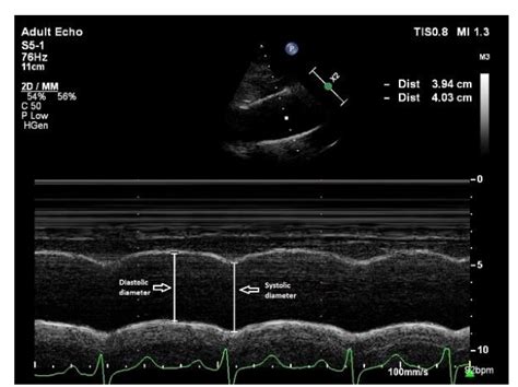 Measurement Of Aortic Diameters Using M Mode Echocardiography In
