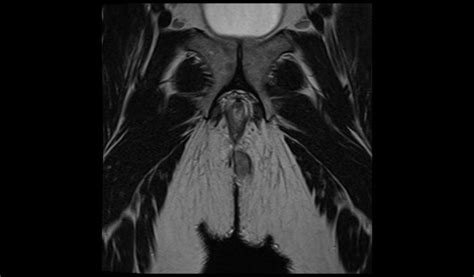 Perianal Fistula Mri Radiology Article On Perianal Fistula Mri