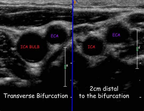 Carotid Doppler Ultrasound Normal Values Leryuu