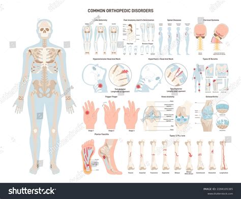 Orthopedic Diseases Set Human Skeleton Ligament Stock Vector Royalty Free 2284105385