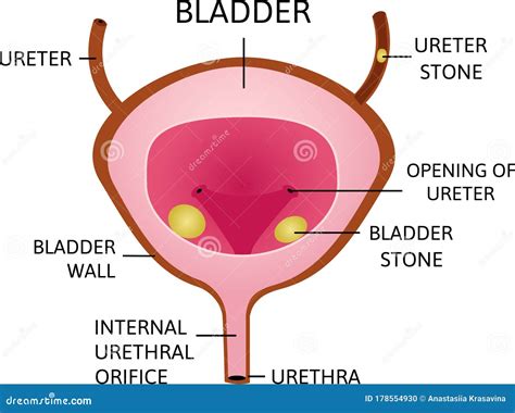 Stones In The Bladder Two Big Stones Inside The Bladder Cavity And One