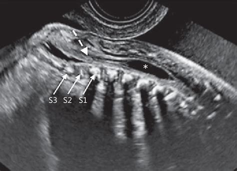 Conus Medullaris Ultrasound