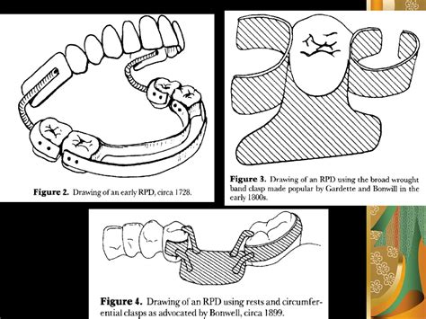 Kennedy Classification Pptx Kennedy Classification Pptx