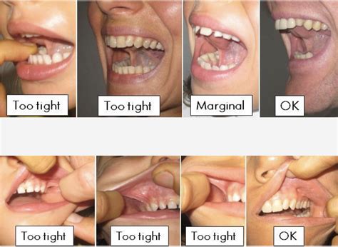 What Does A Tongue Tie Look Like Vs Normal