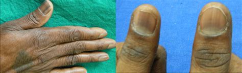 Melanonychia In Hiv Patient Download Scientific Diagram