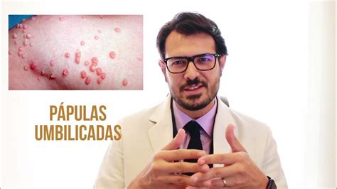 Todo Lo Que Debes Saber De Papulas Perladas Youtube