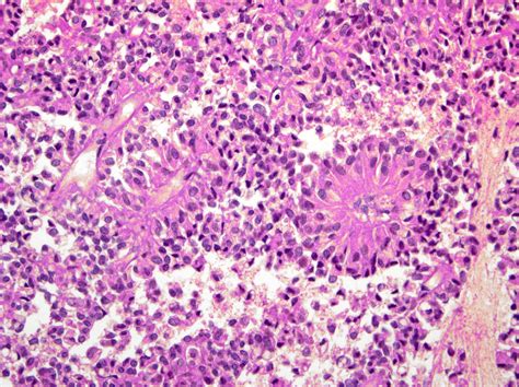 Pathology Outlines Solid Pseudopapillary Neoplasm