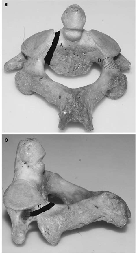 Terminology Used A Superior View Of C2 Vertebra A Anatomic Pedicle B Download Scientific