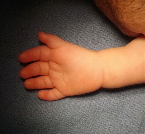 Not The Typical Thumb And Wrist Congenital Hand And Arm Differences