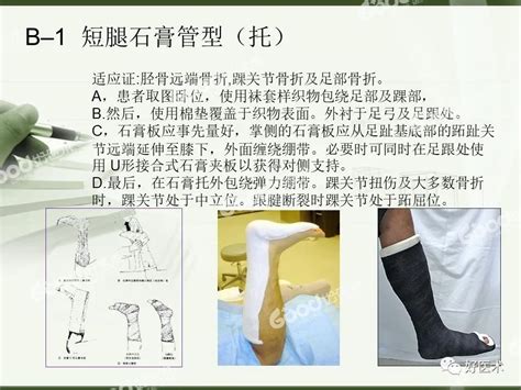 骨科必备石膏绷带与夹板固定图文示教超清晰 好医术文章 好医术 赋能医生守护生命