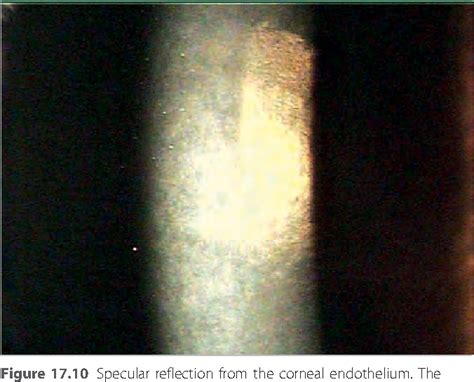 Specular Reflection Cornea