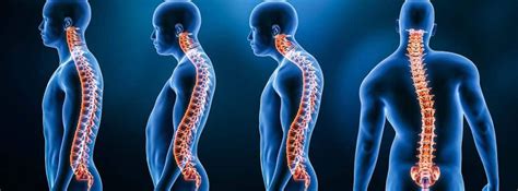 Cifosis dorsal causas diagnóstico y tratamiento canalSALUD