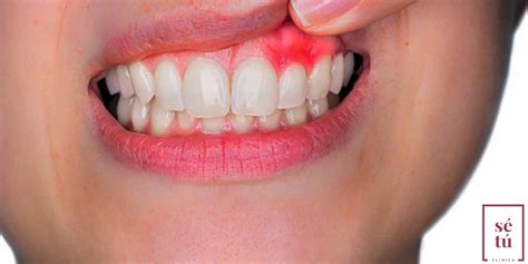 Patologías salud oral herpes labial o úlceras Sé Tú Clínica Dental
