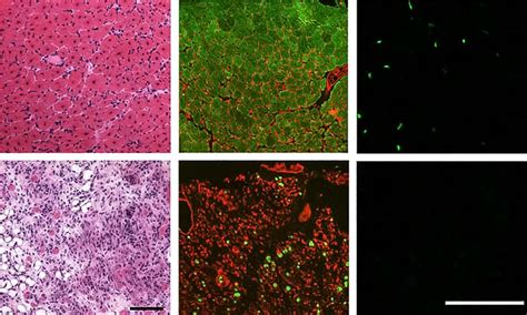 Two Hit Model Of Muscular Dystrophy May Redirect Hunt For Cures Research Horizons