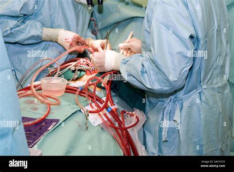 La chirurgie de l aorte À partir de tubes d une machine coeur poumon