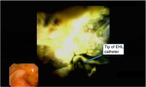 New Management Of Hepatolithiasis Can Surgery Be Avoided With Video