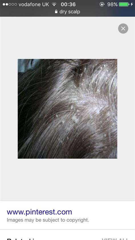 Dry Scalp Symptoms Dry Scaling Infectious No Causes Over