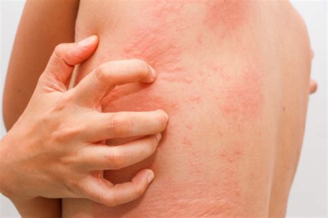 107 Symptoms Of A Staph Infection On Your Skin