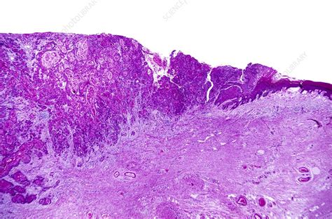 Skin Cancer Light Micrograph Stock Image C0036253 Science Photo