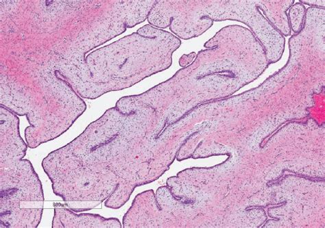Phyllodes Tumor Oncohema Key