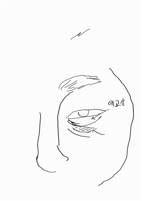 눈밑지방 캐뉼라삽입 제거후 뭉침현상 지식in