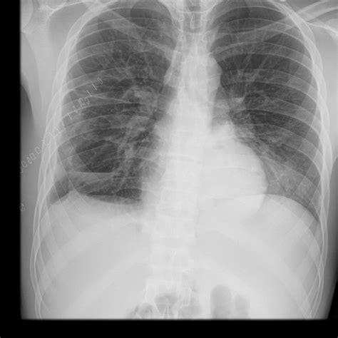 Ct Scan Chest Axial View Download Scientific Diagram