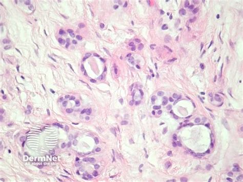 Eccrine Mixed Tumour Pathology