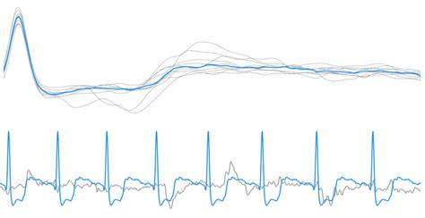 Ecg Noise Removal Using Segmented Beat Modulation Arturo Moncada