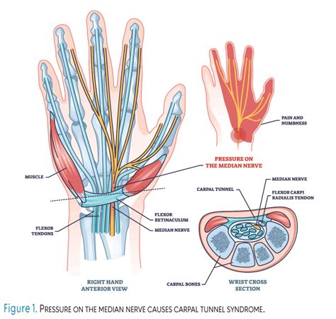 Carpal Tunnel Syndrome Demystified Dimensions Of Dental Hygiene
