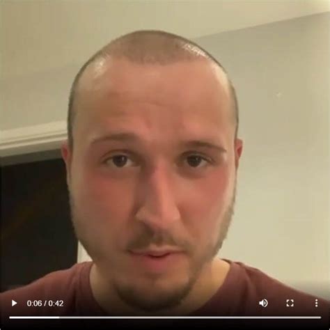 Blonde Hair Transplant Procedure And Costs Heva Clinic Turkey