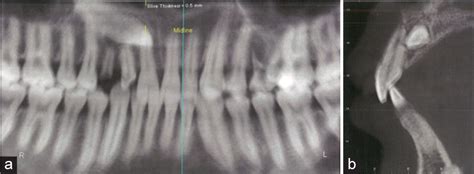 Evaluation Of A Correlation Between The Severity Of Root Resorption Of